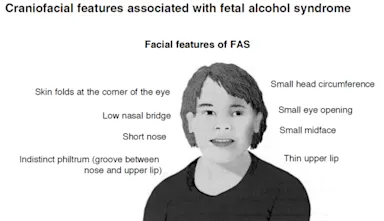 Fetal Alcohol Syndrome: Signs & Symptoms
