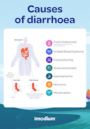 Causes Of Nausea And Diarrhea