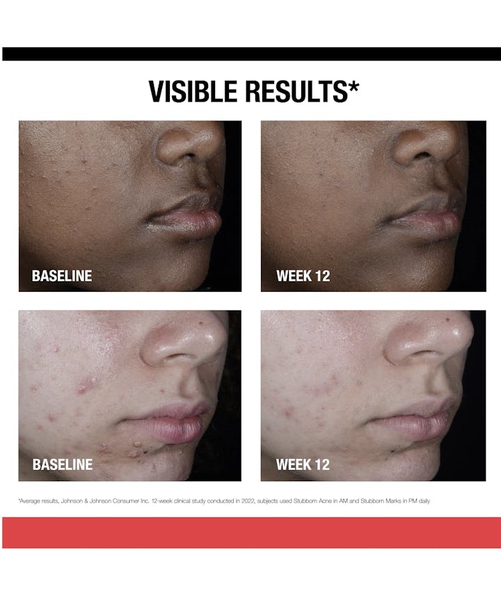 Stubborn Marks PM Acne Treatment With Retinol | NEUTROGENA®