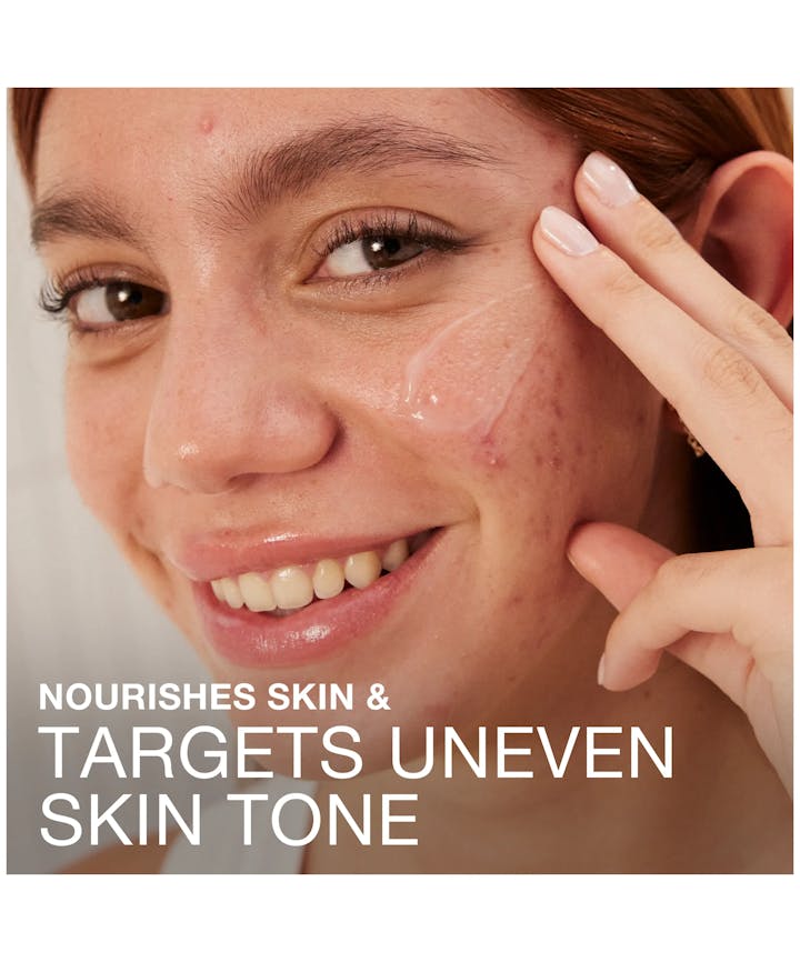 Ultra Face Lightweight Gel Cream Hydrator for Acne