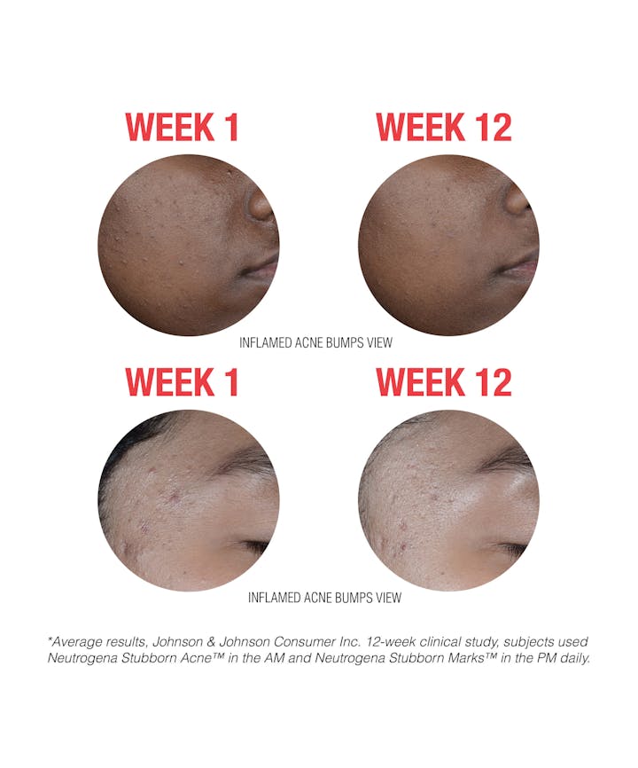 Stubborn AM Acne Treatment With Benzoyl Peroxide