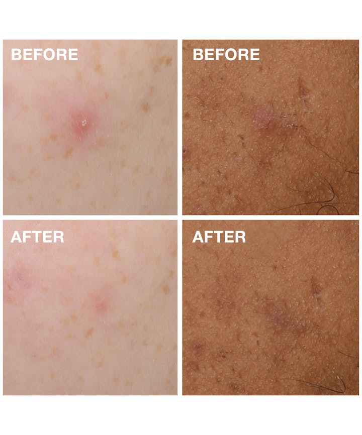 Stubborn Acne™ Spot Drying Lotion to Shrink Pimples