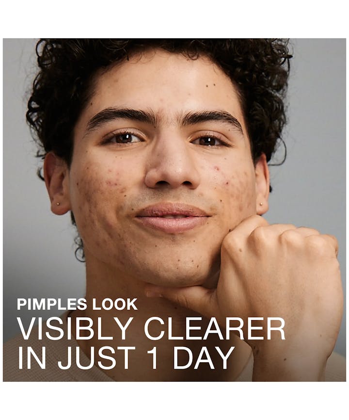 Stubborn Acne™ Spot Drying Lotion to Shrink Pimples