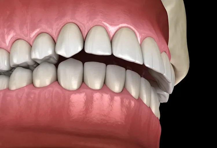 Overjet Vs Overbite Whats The Difference Byte®