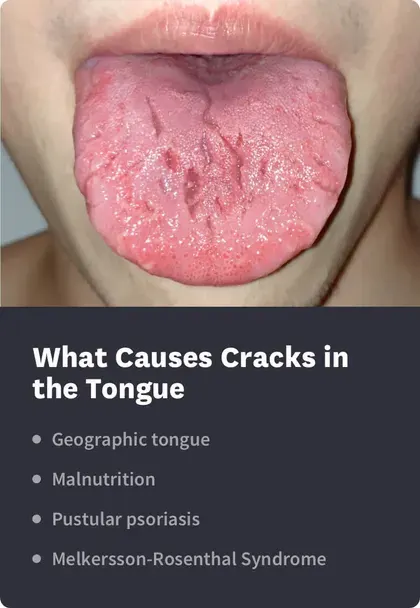 Cracks in Tongue - Causes & Treatment for Fissured Tongue | Byte® | Byte®