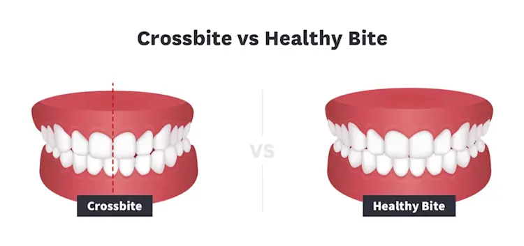 Fixing a Crossbite: You Don't Always Need Braces | Byte® | Byte®