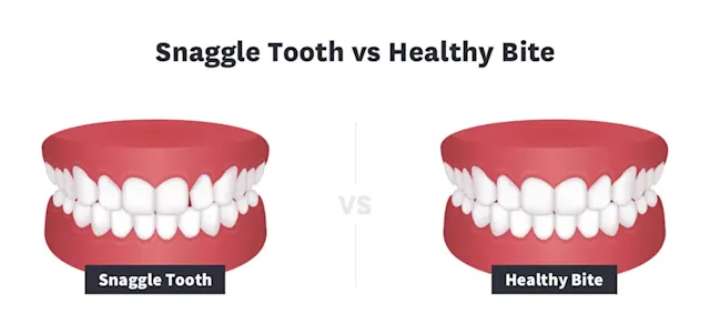 How to Fix a ‘Snaggle Tooth’: Options, Costs & More | Byte® | Byte®