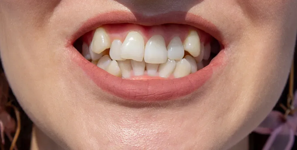 How to Fix a ‘Snaggle Tooth’: Options, Costs & More | Byte® | Byte®