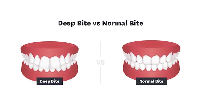 What Does It Mean If You Have A Deep Bite? How To Fix It | Byte®