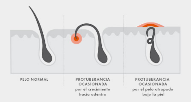 Cómo tratar los pelos enquistados y el sarpullido | Gillette ES