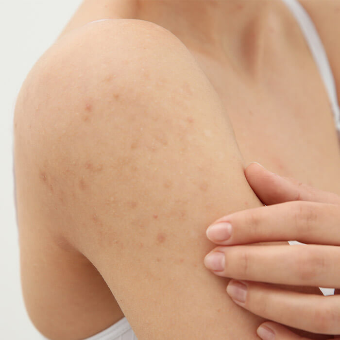 All About Fungal Acne and How to Treat It
