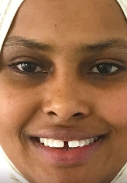 Clear aligners for straight teeth | PlusDent