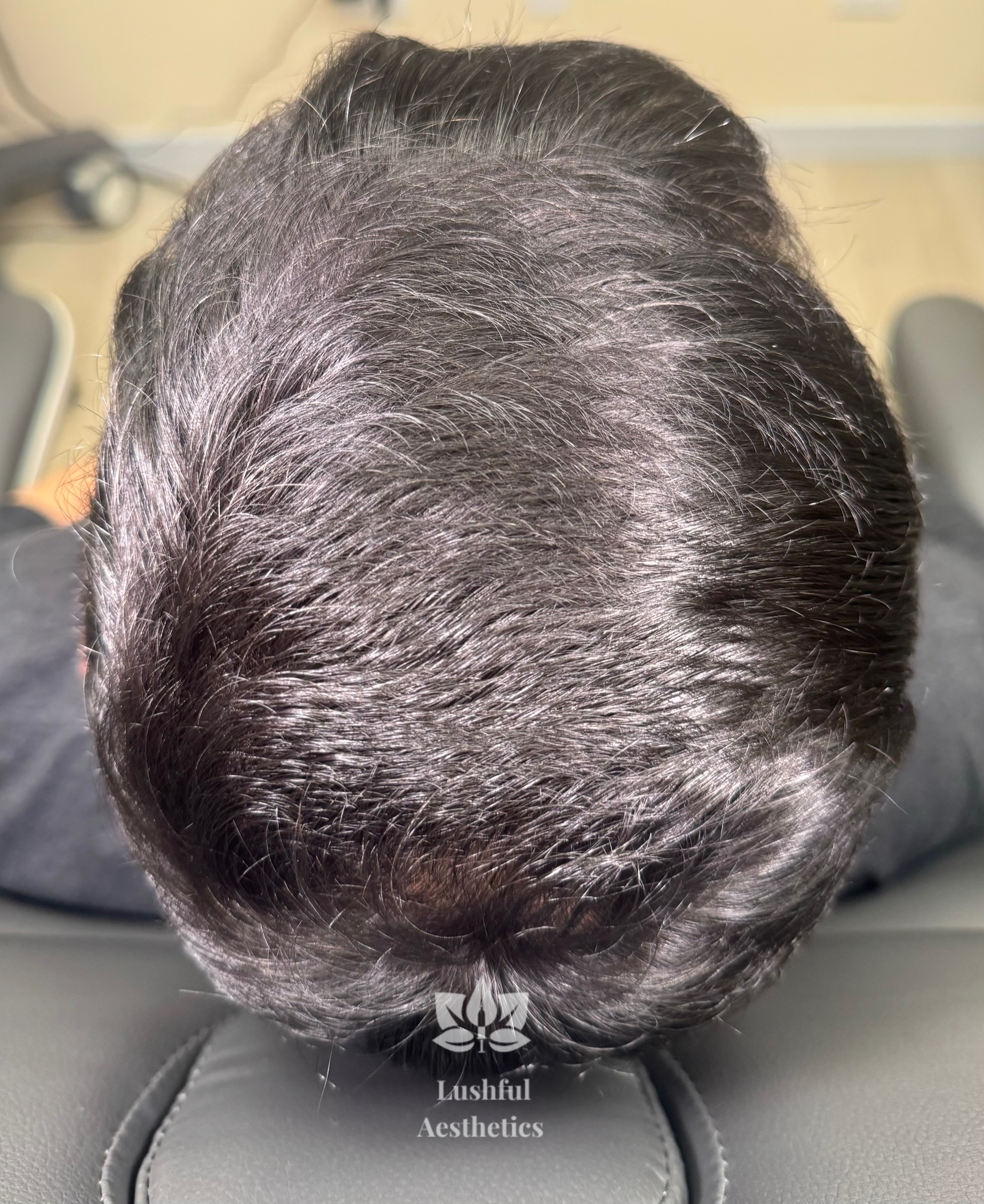 Alma Ted Hair Restoration Treatment - NYC | Lushful Aesthetics