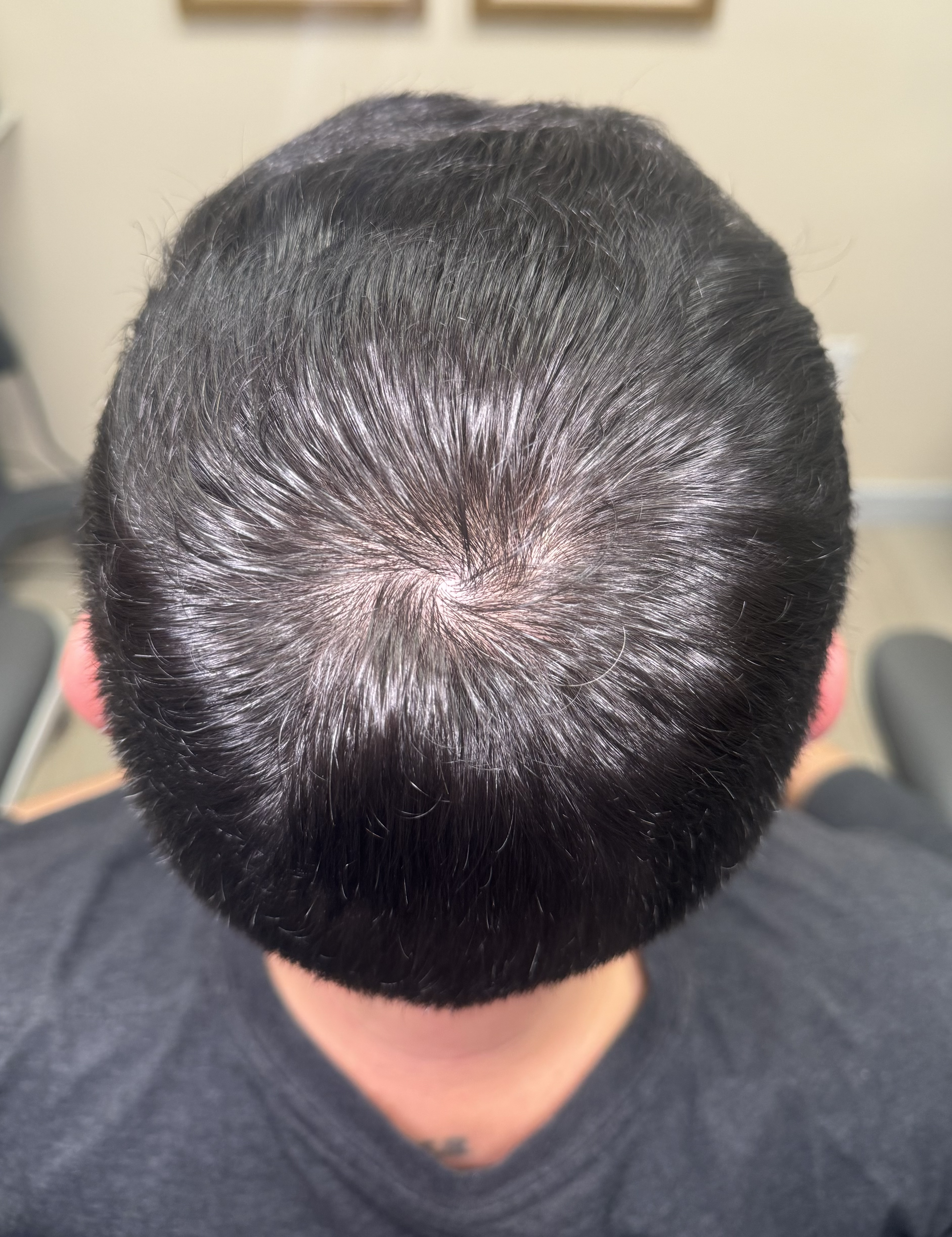 Alma Ted Hair Restoration Treatment - NYC | Lushful Aesthetics