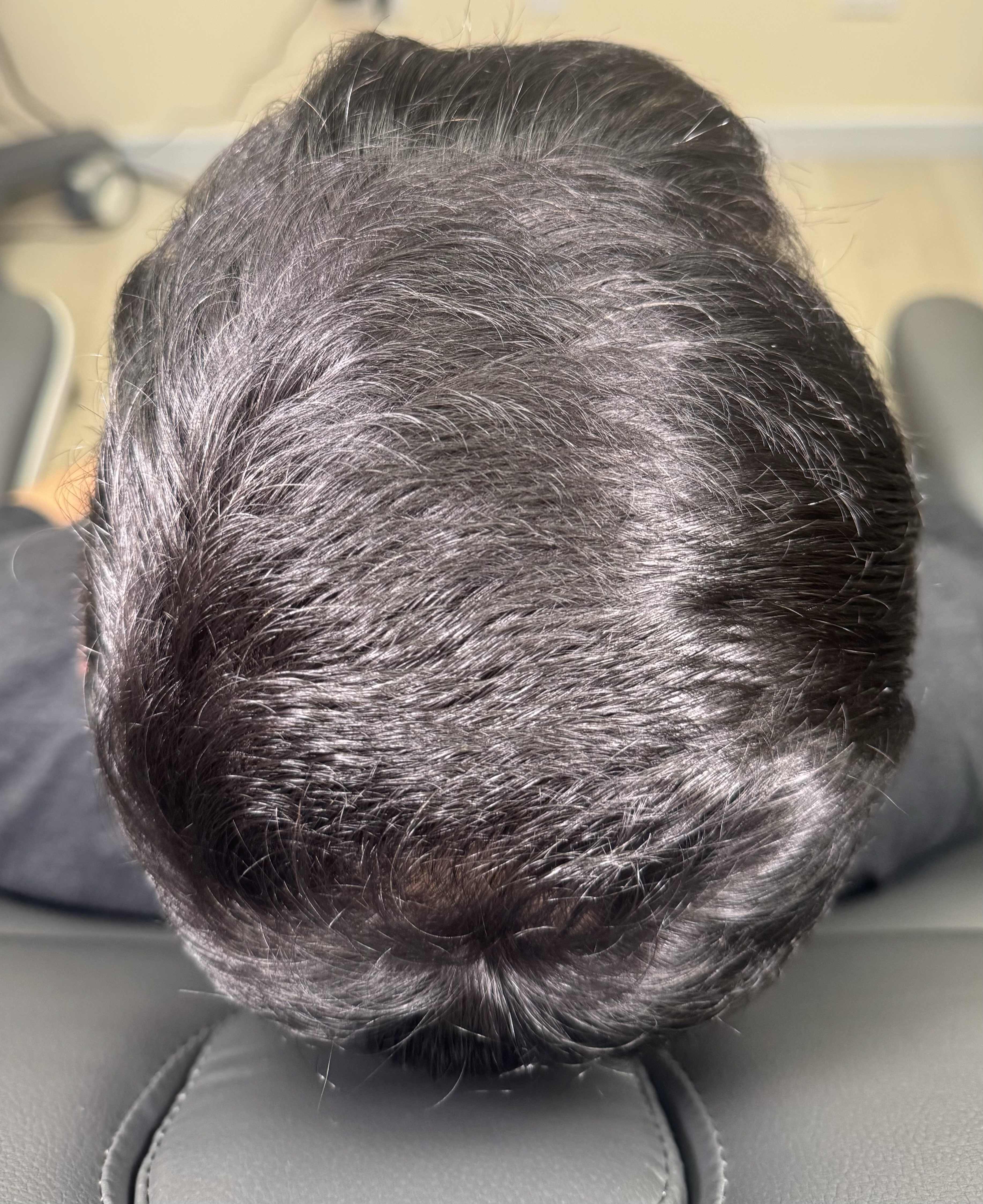 Alma Ted Hair Restoration Treatment - NYC | Lushful Aesthetics