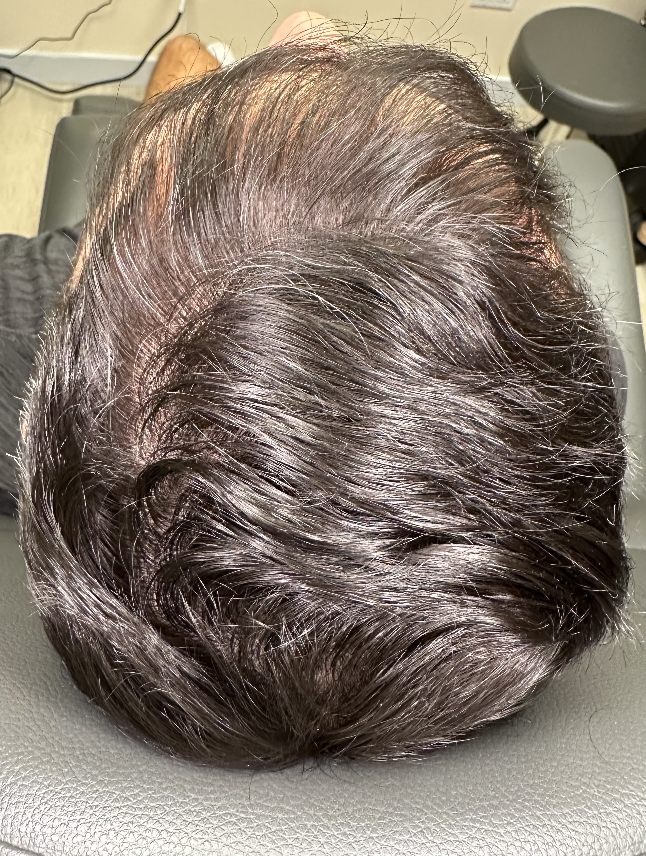 Alma Ted Hair Restoration Treatment - NYC | Lushful Aesthetics