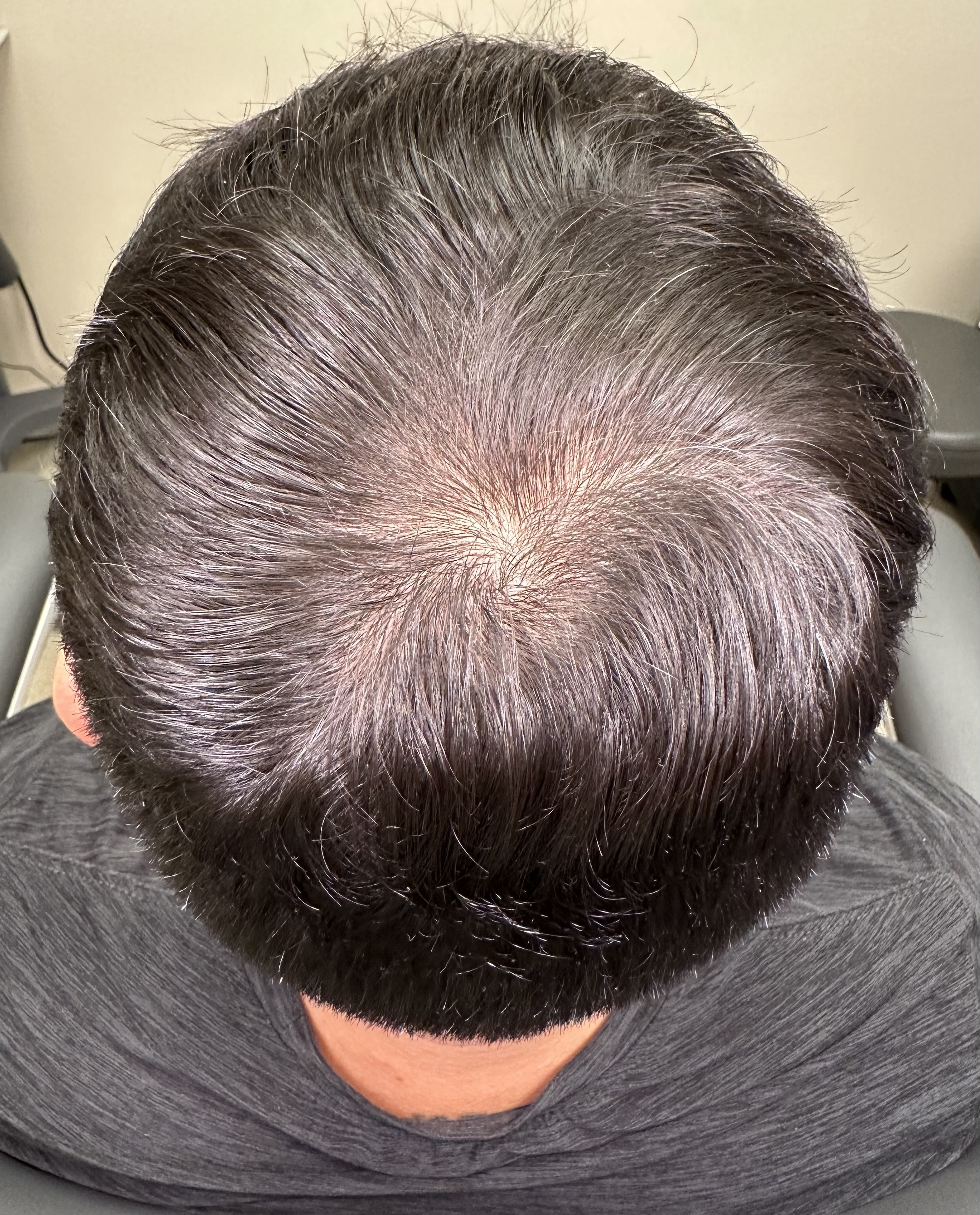 Alma Ted Hair Restoration Treatment - NYC | Lushful Aesthetics