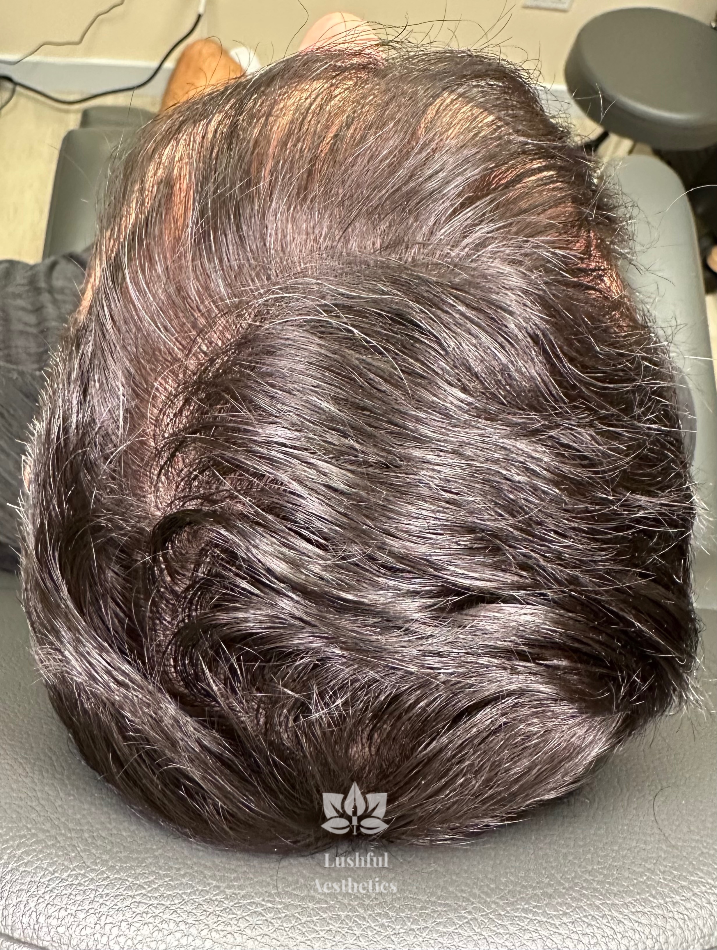 Alma Ted Hair Restoration Treatment - NYC | Lushful Aesthetics