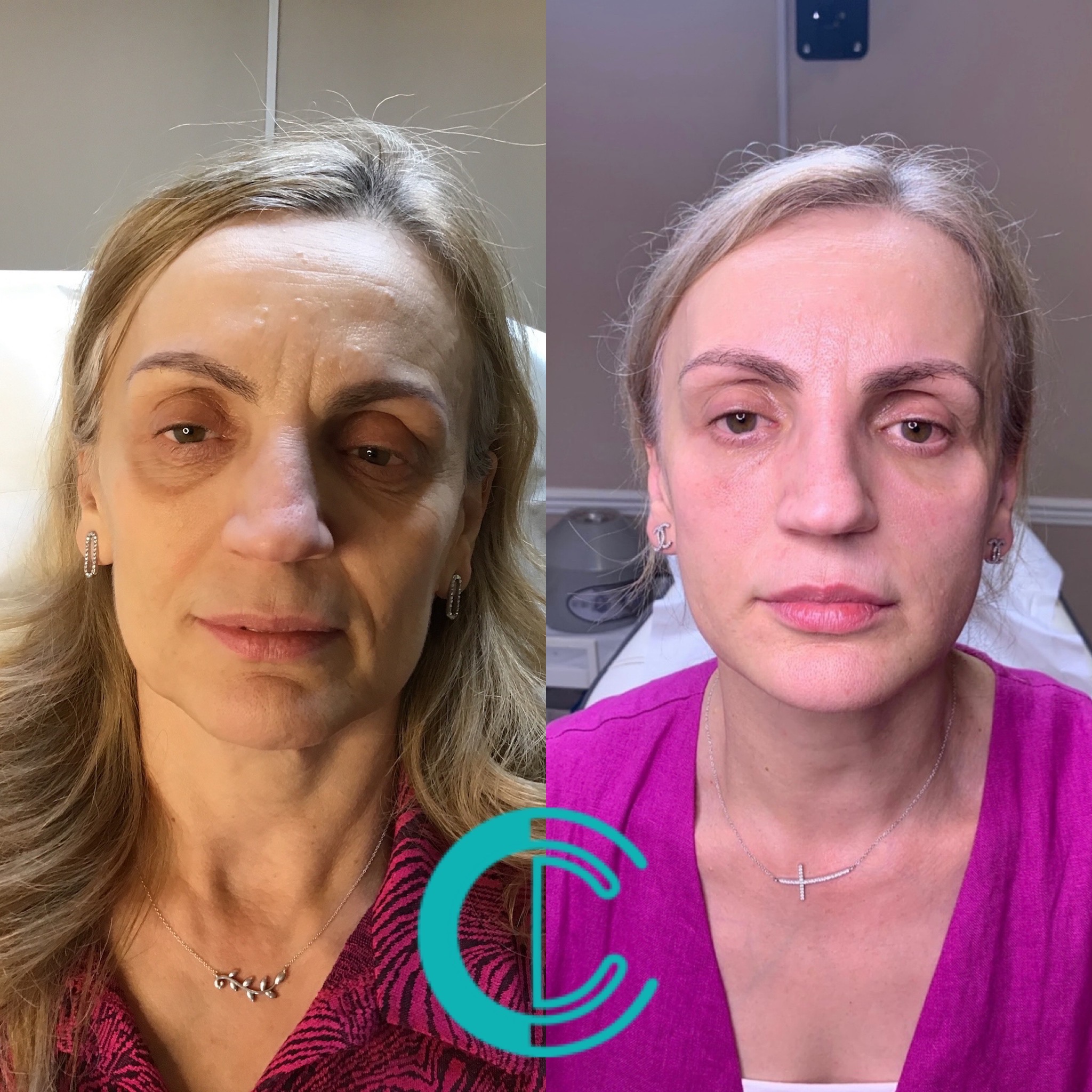 Plasma Bio Gel Filler Training Courses | Cosmetic College