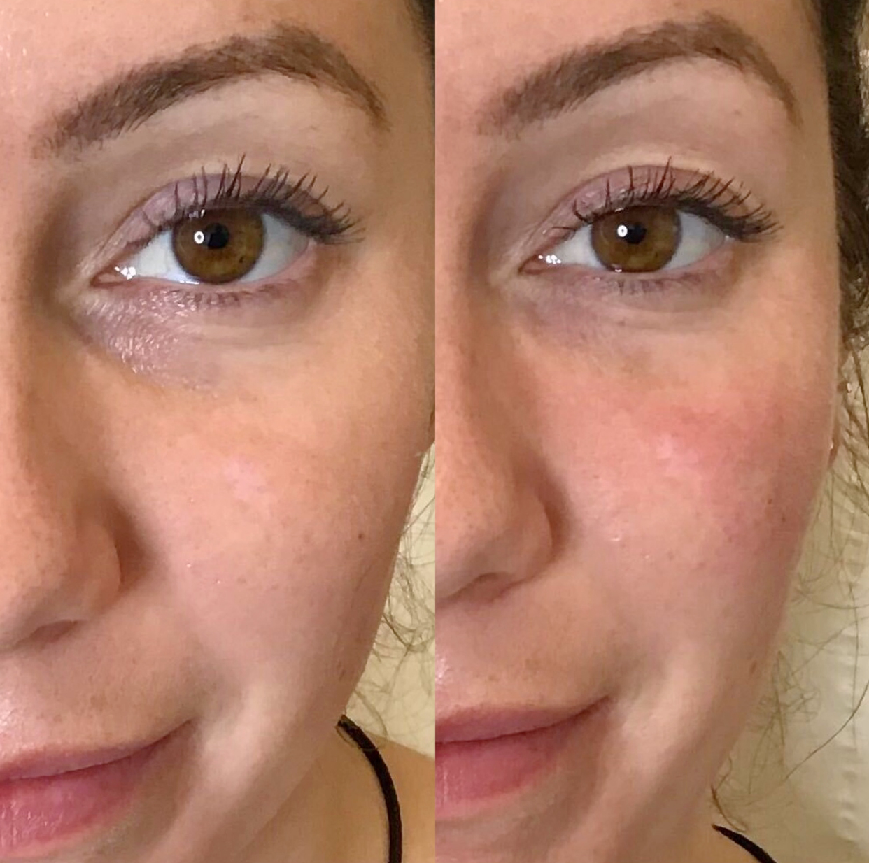 Tear Trough Dermal Filler Masterclass | Cosmetic College