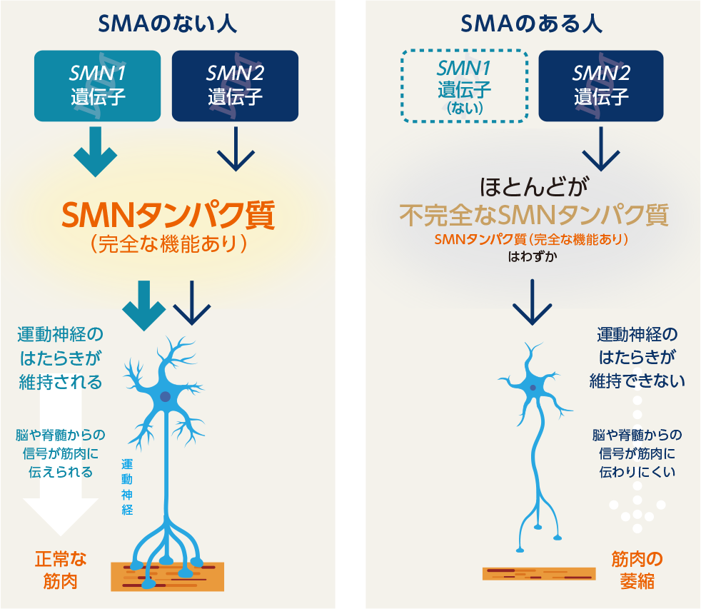 SMAについて | 赤ちゃんのSMA | スピンラザ®を使用される患者さんへ