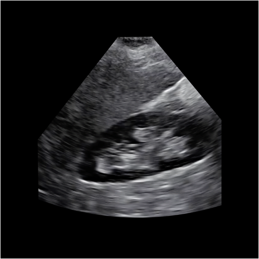 Exo Iris™ | Handheld Ultrasound | Exo