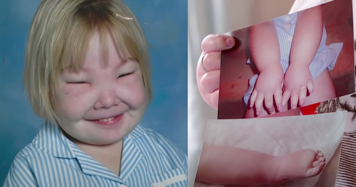 Teen Born With Rare Condition That Causes Fluid To 'Float' In Entirely ...