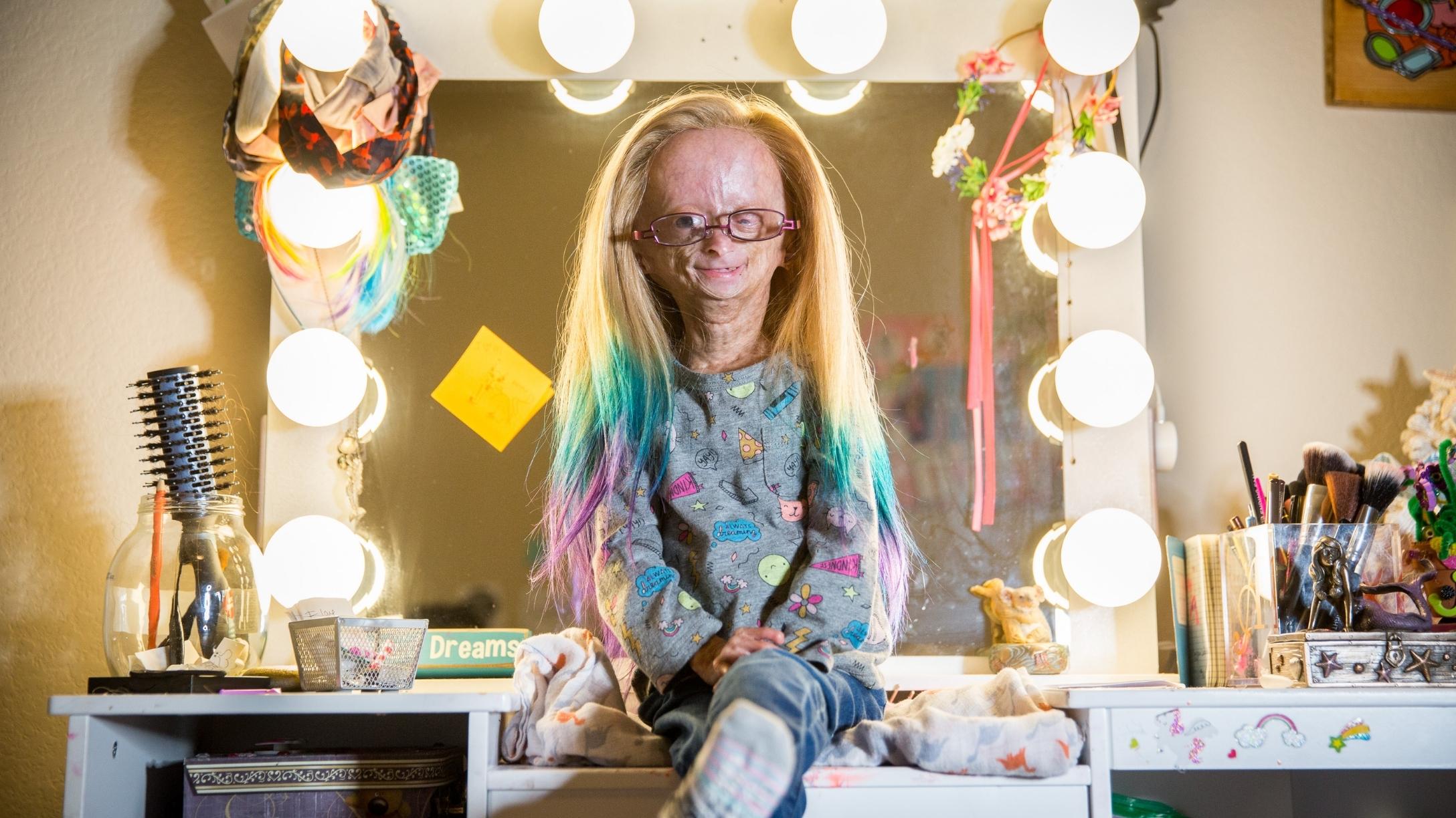 YouTuber Who Became Famous For Living With An Early-Aging Disorder Dies ...