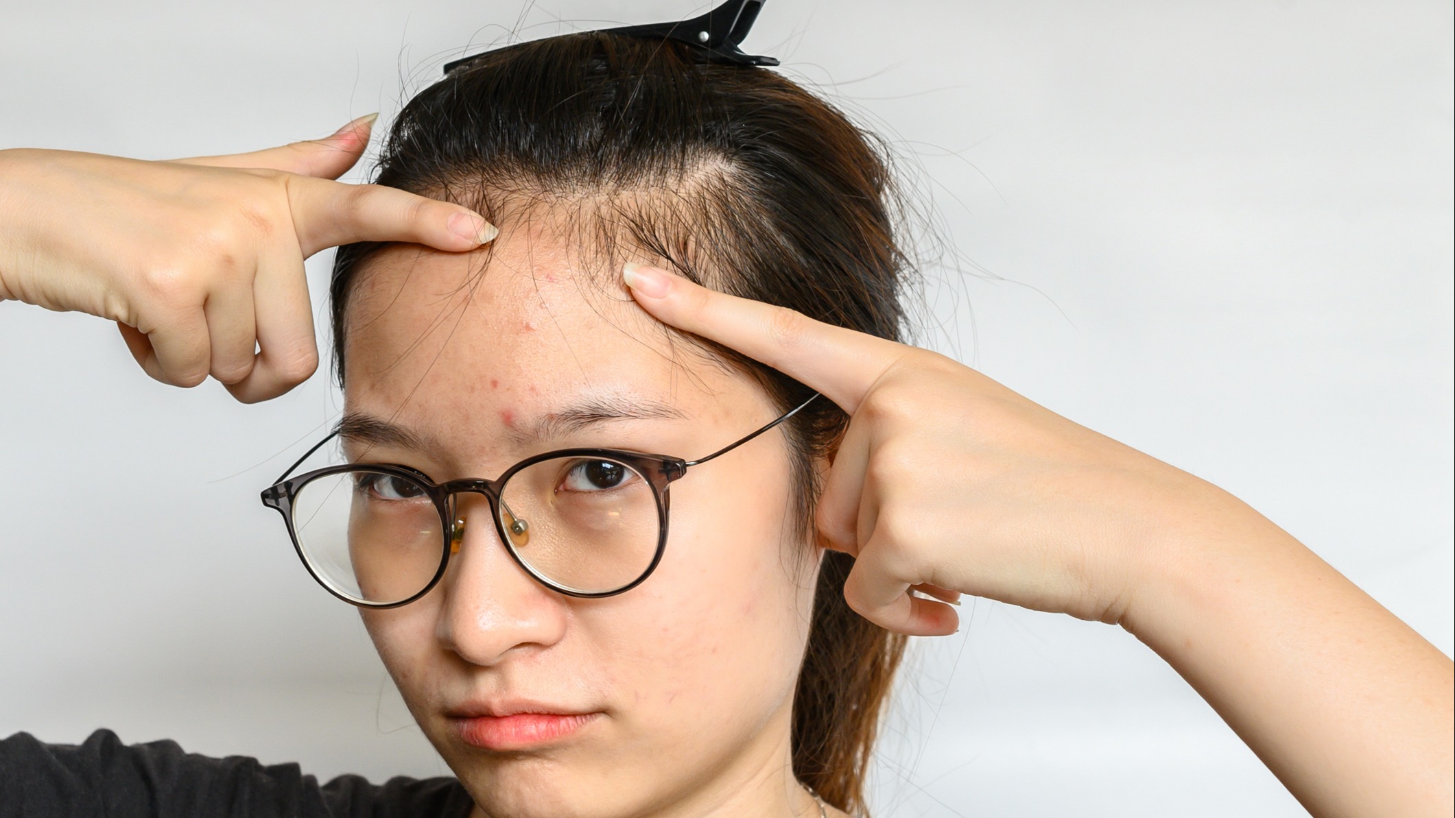 How To Help Your Teen Navigate & Treat Their Skin-Picking Or Hair ...