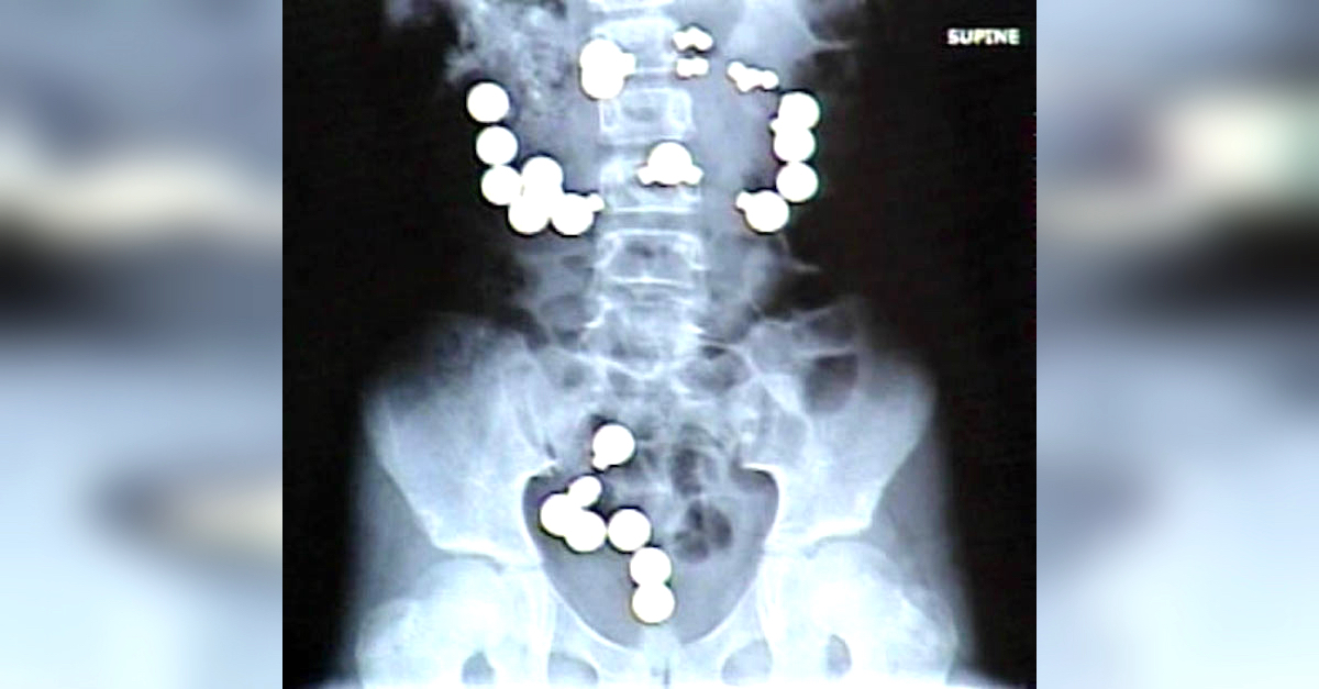 X-Ray Surprises: 12 Unexpected Items Doctors Discovered Inside Their ...