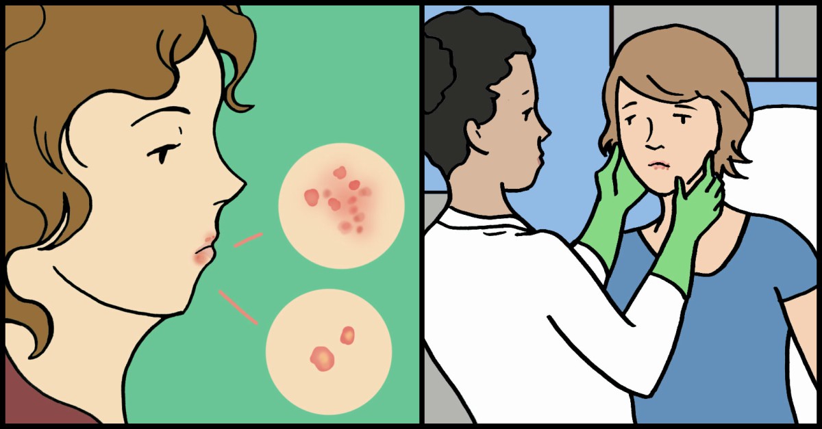 10 Things Everyone Should Know About Cold Sores | LittleThings.com