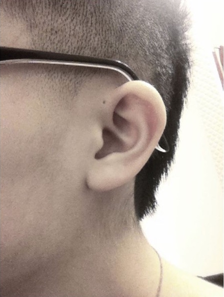 The Fascinating Reason Why Some People Have A Small Hole Above Their ...