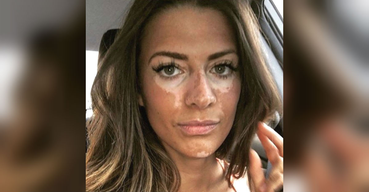 Model Hid White Patches On Face For 10 Years, Then Finally Shares ...