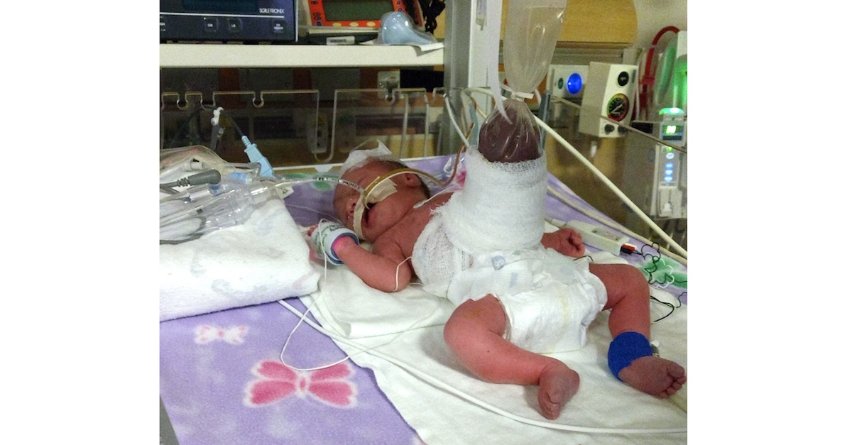 Premature Baby Is Born With Intestines Outside Body | LittleThings.com