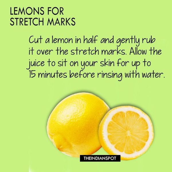 10 Remedies To Get Rid Of Stretch Mark And It Actually Works ...