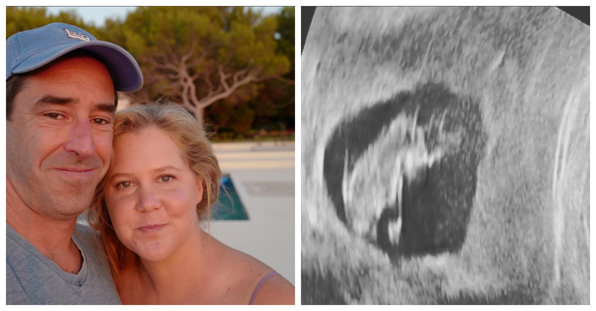 Amy Schumer Shares Sweet Ultrasound Video Of Her Baby | LittleThings.com
