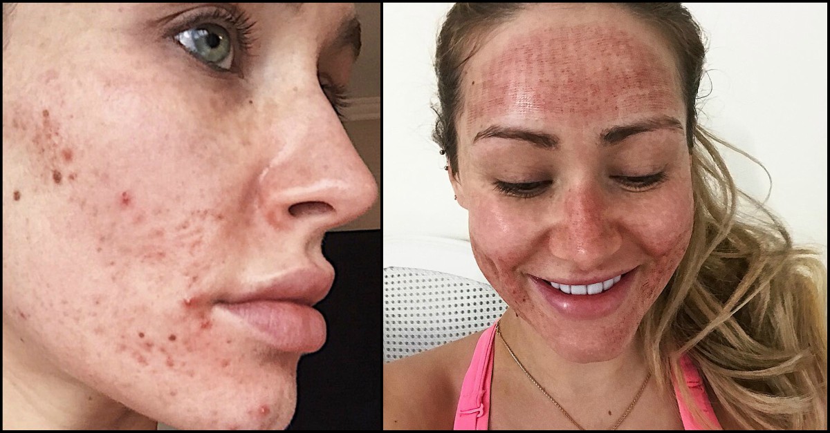 Instagram Star Says Painful Acne Treatment Was Worth It | LittleThings.com