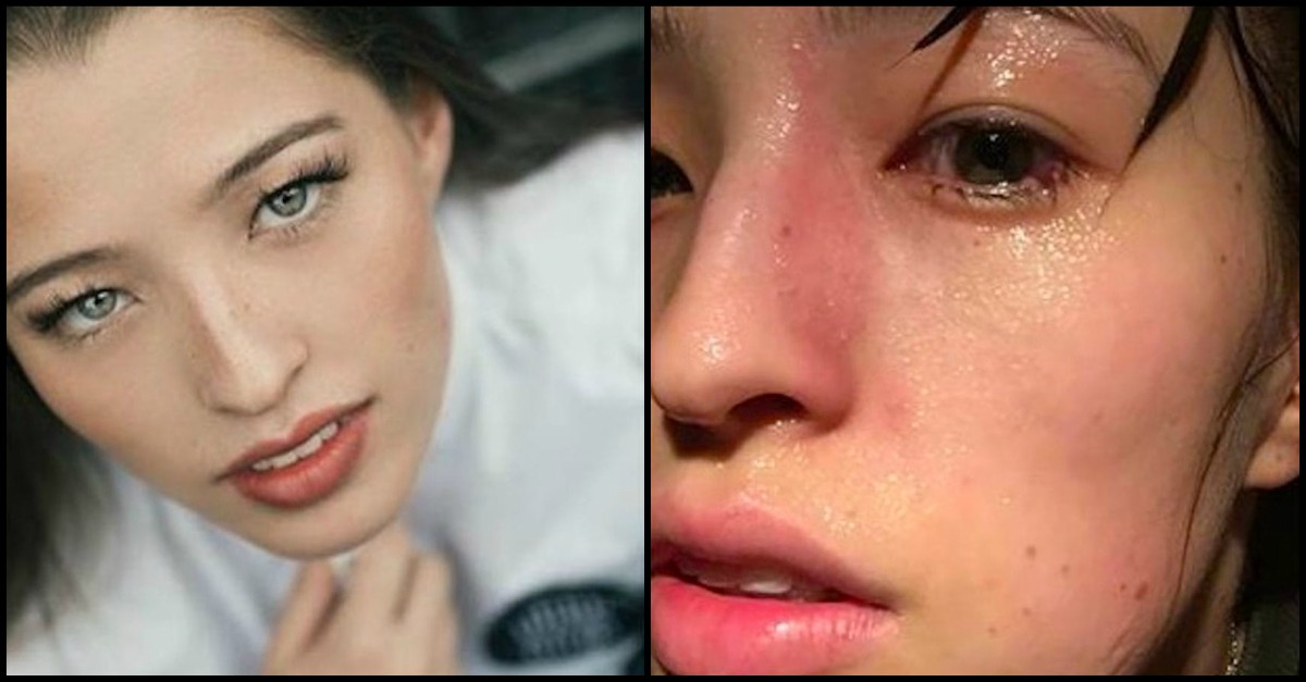 Woman Shares Facial Burn Photos After Oil Diffuser Mishap ...