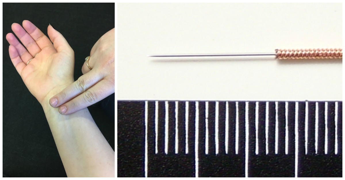 How Does Acupuncture Work? 10 Things You Need To Know | LittleThings.com