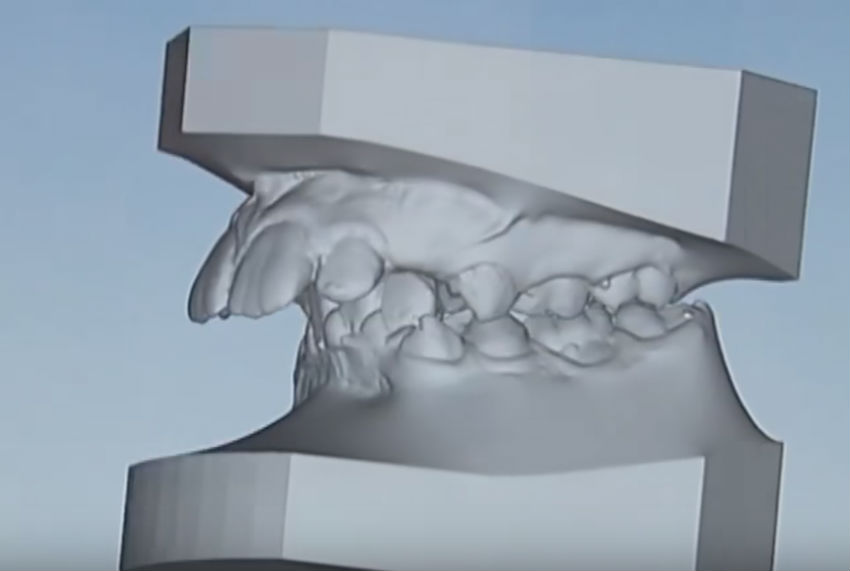 Strangers Help Bullied Boy With Giant Buck Teeth Get New Smile