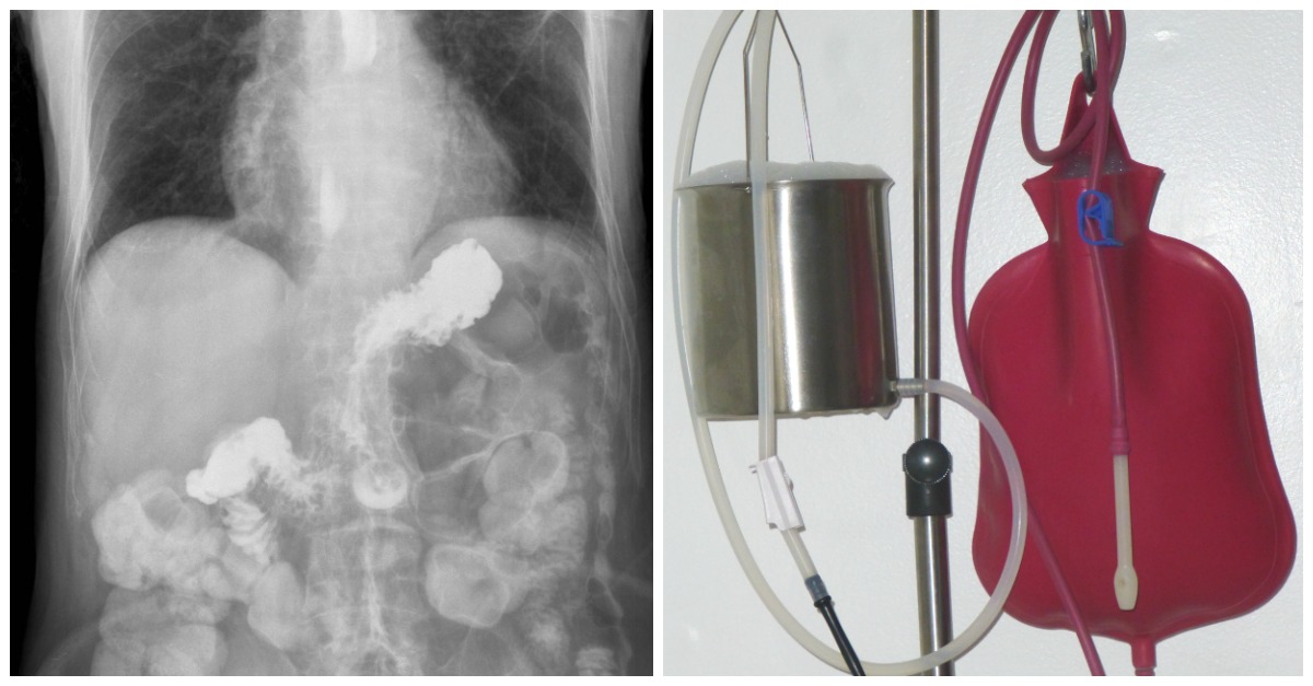 Signs You Need To Get A Colonoscopy Immediately | LittleThings.com