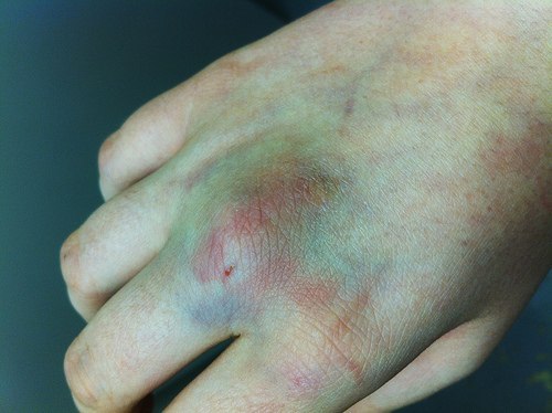 Learn How To Tell And Heal The 5 Different Shades Of Bruises ...