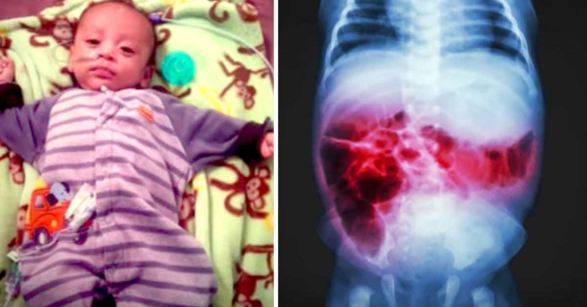 Doctors Are Forced To Remove Baby's Intestines. 3 Years Later, He's The ...