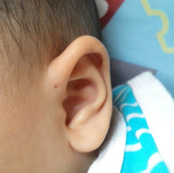 The Fascinating Reason Why Some People Have A Small Hole Above Their ...