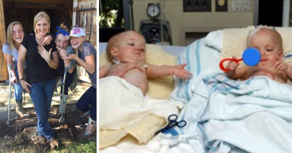 Unique Case Of Conjoined Triplets