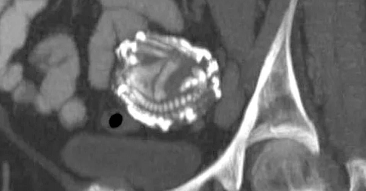 Woman Gives Birth To 'Stone Baby' 46 Years After It Was Conceived ...