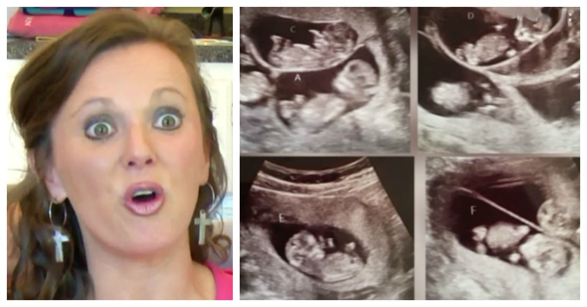 Sextuplets In The Womb