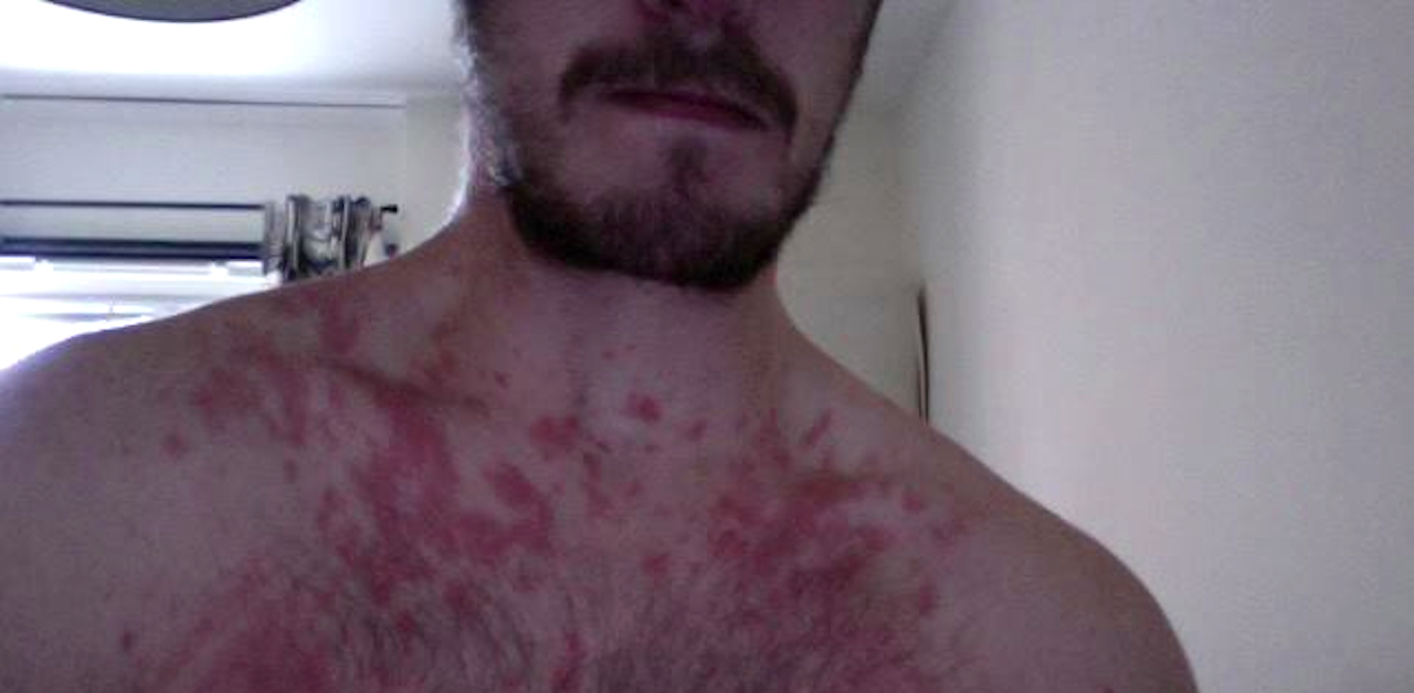 Psoriasis Beard