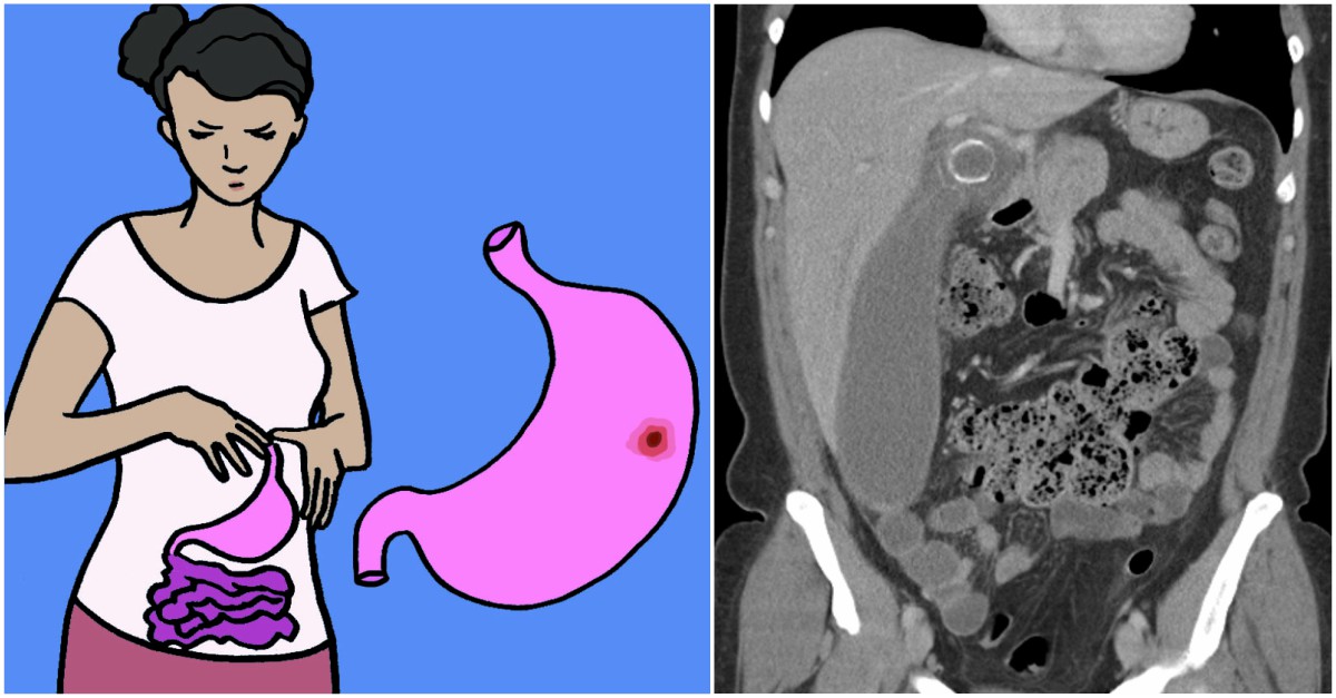 7 Alarming Signs And Symptoms Of A Stomach Ulcer | LittleThings.com