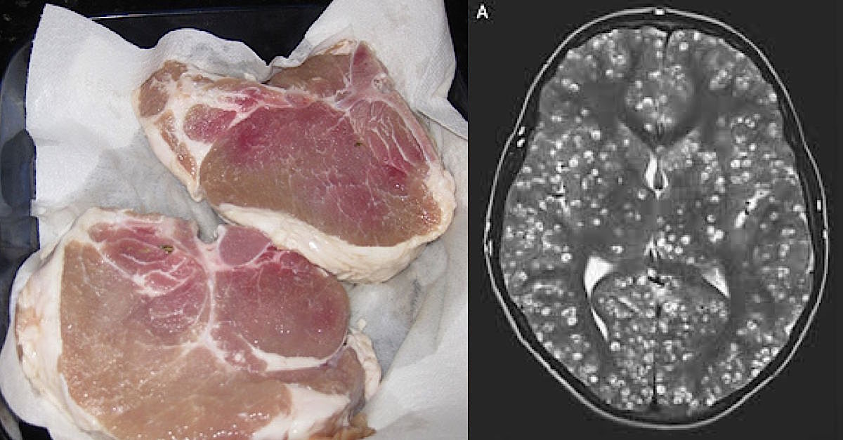 Teen Dies After Doctors Find Tapeworm Eggs In Her Brain | LittleThings.com
